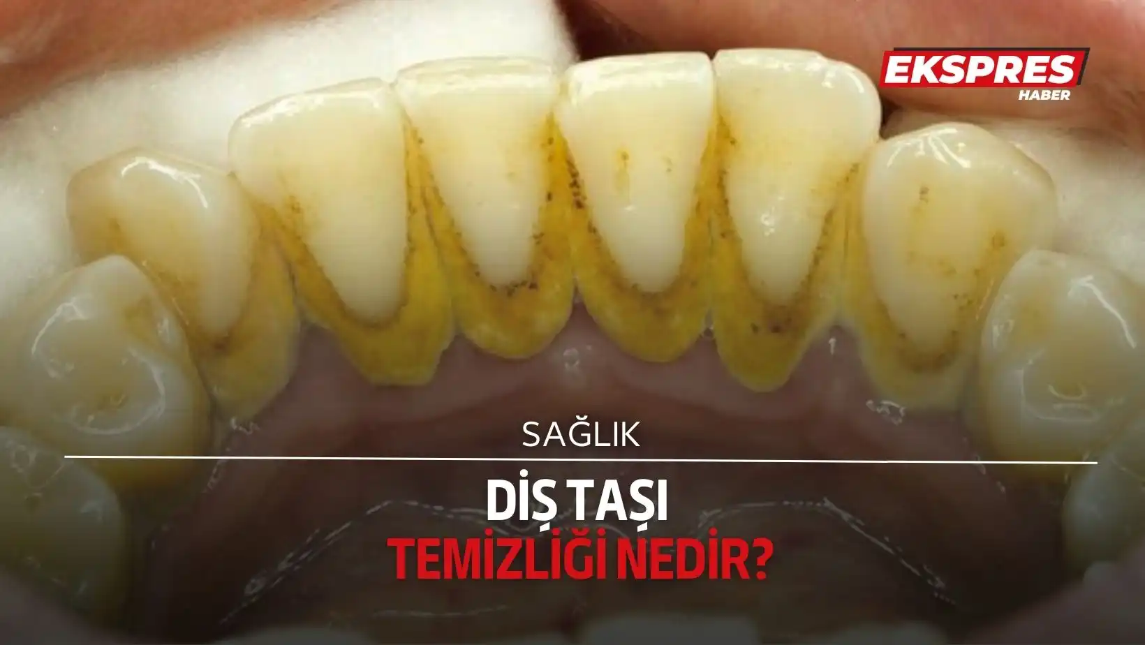 Diş taşı temizliği nedir, nasıl yapılır? - Kütahya Ekspres