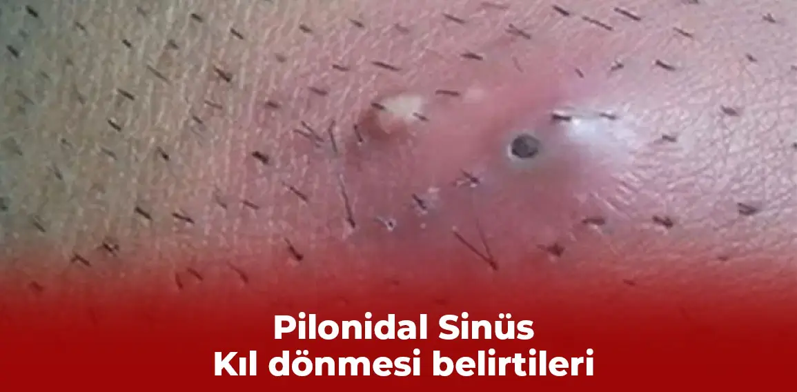Kıl dönmesi belirtileri ve tedavisi ( Pilonidal Sinüs ) - Kütahya Ekspres